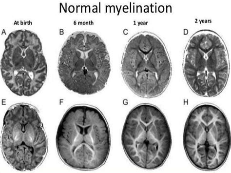 Mri Evaluation Of Pediatric White Matter Lesions