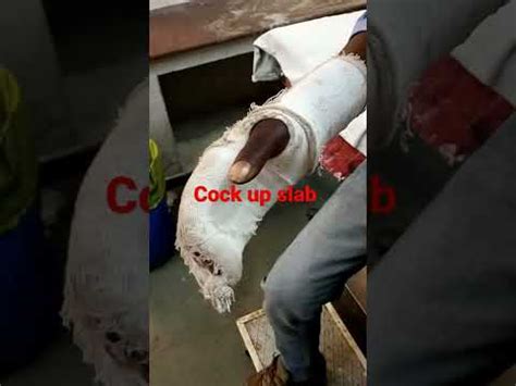 Cock Up Slab Wrist Fracture Scaphoid Fracture Dr Kuldeep Pt