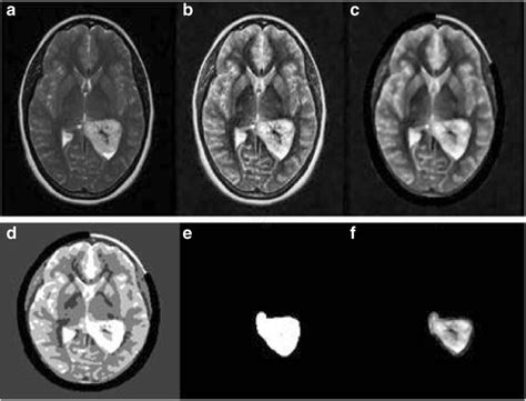 A Input Image B Enhancement C Genetic Optimized Median Filter Output