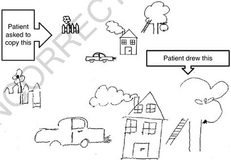 5 A Visuo Spatial Neglect Patient Was Asked To Copy The Top Picture