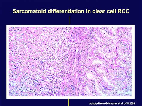 Case First Line Treatment In A Patient With Sarcomatoid Rcc Joaquim Bellmunt M D Youtube