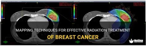 Mapping Techniques For Effective Radiation Treatment Of Breast Cancer