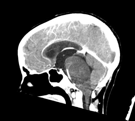 Diffuse Midline Glioma Radiology Case Radiopaedia Org