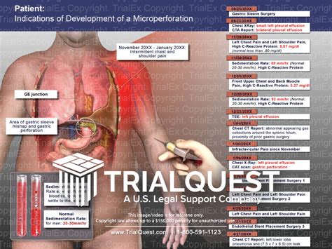 Indications Of Development Of A Microperforation Trial Exhibits