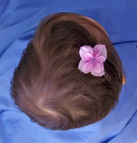 Lambdoid Synostosis Facts And Photos Craniosynostosis