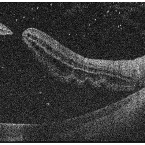 Pattern Visual Evoked Potential Vep And Pattern Electroretinography Download Scientific