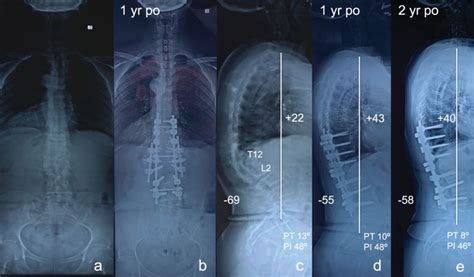 Preoperative Standing Radiographs A And C Show Short Angular Kyphosis