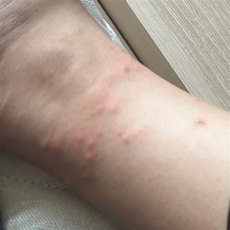 발목 빨간 점 간지러움 지식in