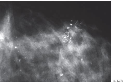 Multiple Clusters Of Crushed Stone Like Calcifications On The Mammogram Produced By Malignant