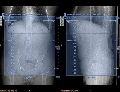 Antero Posterior Ap And Lateral Ct Scanogram Demonstrated The 2