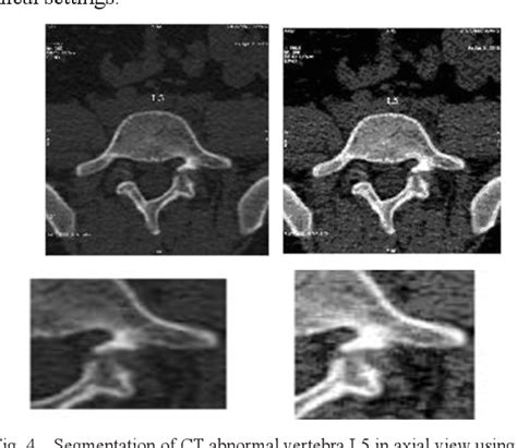 Figure 1 From Kernel Based Fcm For Spinal Cord Segmentation On Computed
