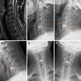A 45 Year Old Woman Receiving Dynamic Cervical Implant Arthroplasty Due