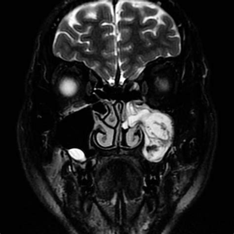 Convoluted Cerebriform Pattern Radiology Reference Article