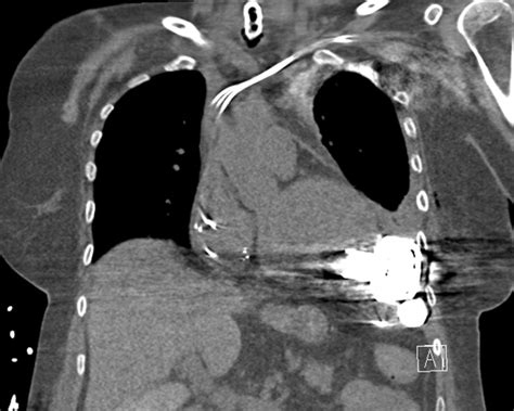 Postoperative Computed Tomography Demonstrates Adequate Inflow Cannula
