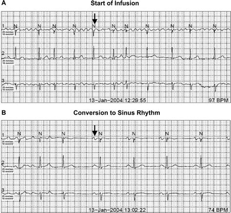Safe And Effective Conversion Of Persistent Atrial Fibrillation To