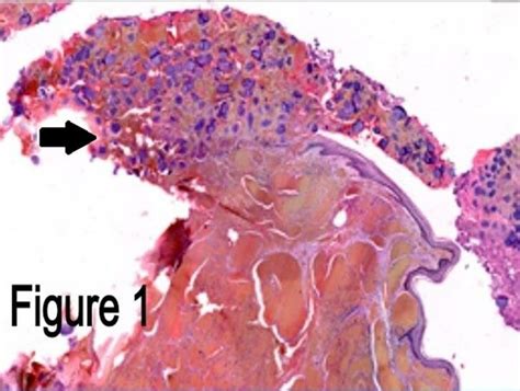 Cavernous Hemangioma In Dermis With Basophilic Bodies Arrow Along Download Scientific Diagram