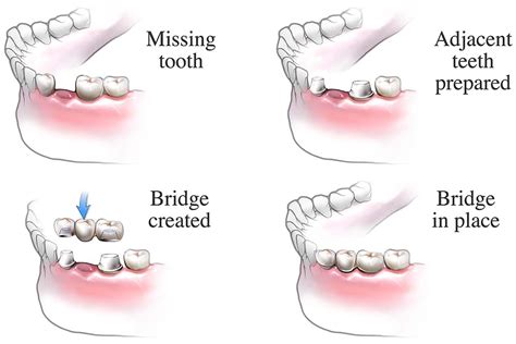 Dental Bridge Healthdirect