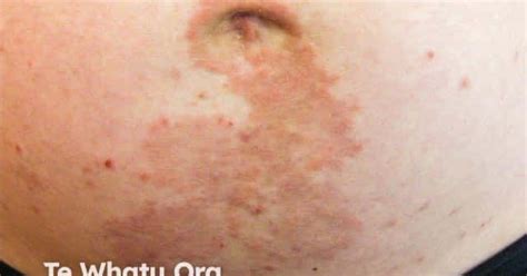 Pemphigoid Gestationis 00028 Image