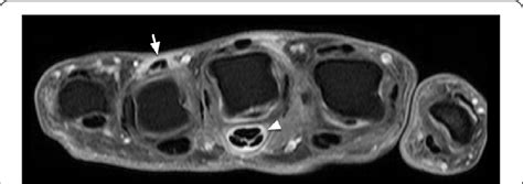 Example Mr Image Of Extensor Tenosynovitis At Mcp 4 Arrow And Flexor