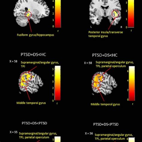 Fig Ure 2 Between Group Resting State Functional Connectivity Results Download Scientific