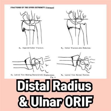 Distal Radius And Ulnar Orif 손목골절 수술 Os3