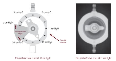Ventricular Shunt Reference Cohen Collection Volumes The Neurosurgical Atlas