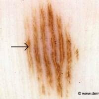 Acral Lentiginous Melanoma