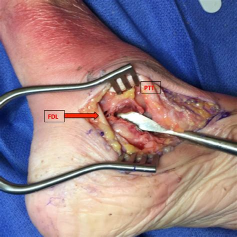 Joint Preparation Of The Subtalar Joint Using Manual Instrumentation Download Scientific Diagram