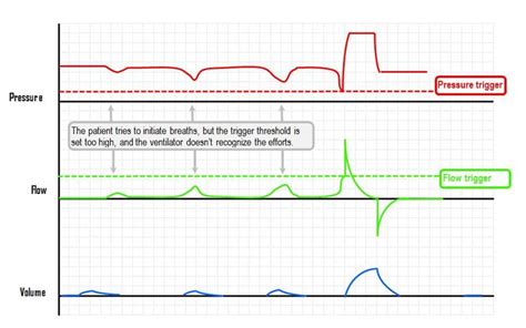 Patient Ventilator Dyssynchrony Deranged Physiology Intracranial Pressure Respiratory