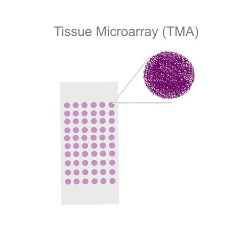 Human Cell Microarray Technology In Detecting Cidp Related Autoantibodies