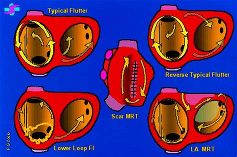 Pin By Nonas Arc On Atrial Flutter Atrial Flutter Conduction Atria