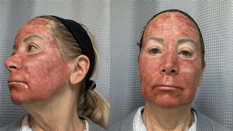 How Can I Speed Up Healing After Co2 Laser