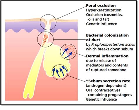 Hyperkeratinization Acne