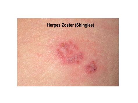 Rashes Different Types Of Rashes Diagnosis PPTX Infectious Diseases Diseases And