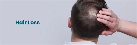 Natural Solutions For Hair Loss Remedies And Tips