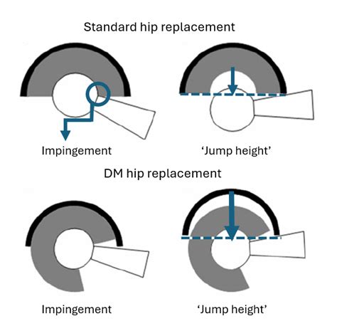 Dual Mobility Hip Testing Orthopaedic Innovation Centre