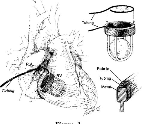 Figure 1 From Local Anticoagulation Of Prosthetic Heart Valves