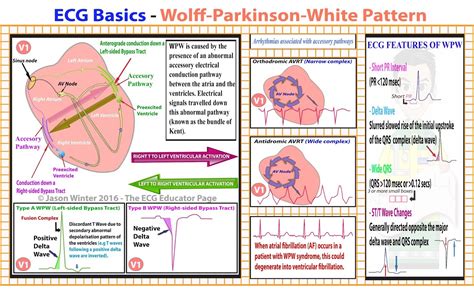 Wolff Parkinson White Syndrome Artofit