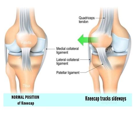 Patella Realignment And Anterior Knee Surgery Mr Michael Moss