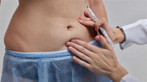 Tummy Tuck Recovery Period Ozge Ergun Md