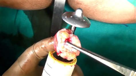 Starr Surgery Stapled Trans Anal Resection Rectopexy Rectocele Recto