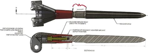 Custom Adapter Design To Mate A Hinged Knee Femoral Prosthesis To The