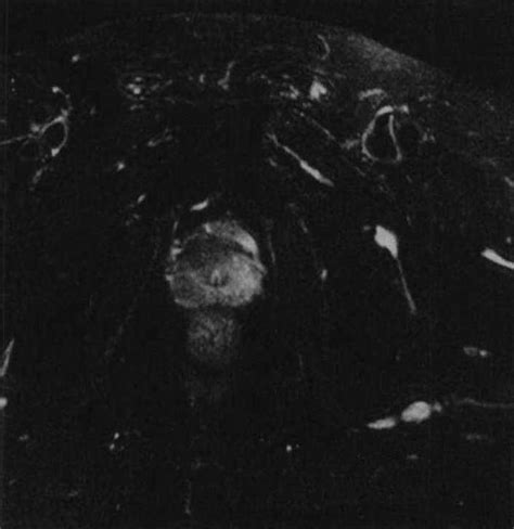 2 前列腺癌 医学影像学诊断和报告