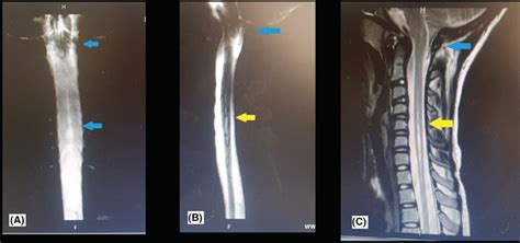 Long Term Craniocervical Mri 12 Months Shows Greater Syrinx