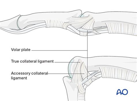 Dorsal Approaches To The Proximal Interphalangeal Joint