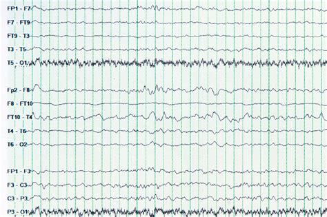 Eeg Basics Waveform Morphology Resource Center