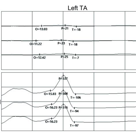A Representative Picture Of Somatosensory Evoked Potentials Sseps Download Scientific