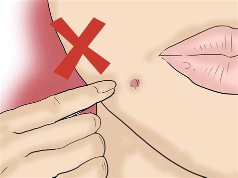 13 Ways To Reduce The Swelling And Redness Of Pimples WikiHow In 2024 Reduce Pimple Redness