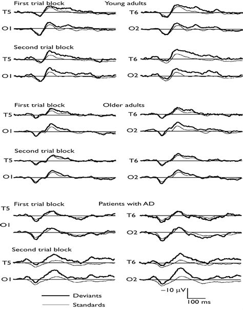 Visual Mismatch Negativity Highlights Abnormal Preattentive Neuroreport