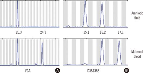 Results Of Str Marker Analysis That Was Performed To Determine Maternal Download Scientific